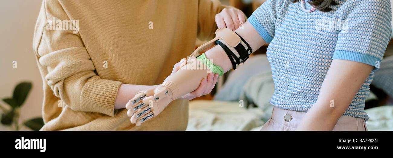 Female having prosthetic arm hi-res stock photography and images - Alamy