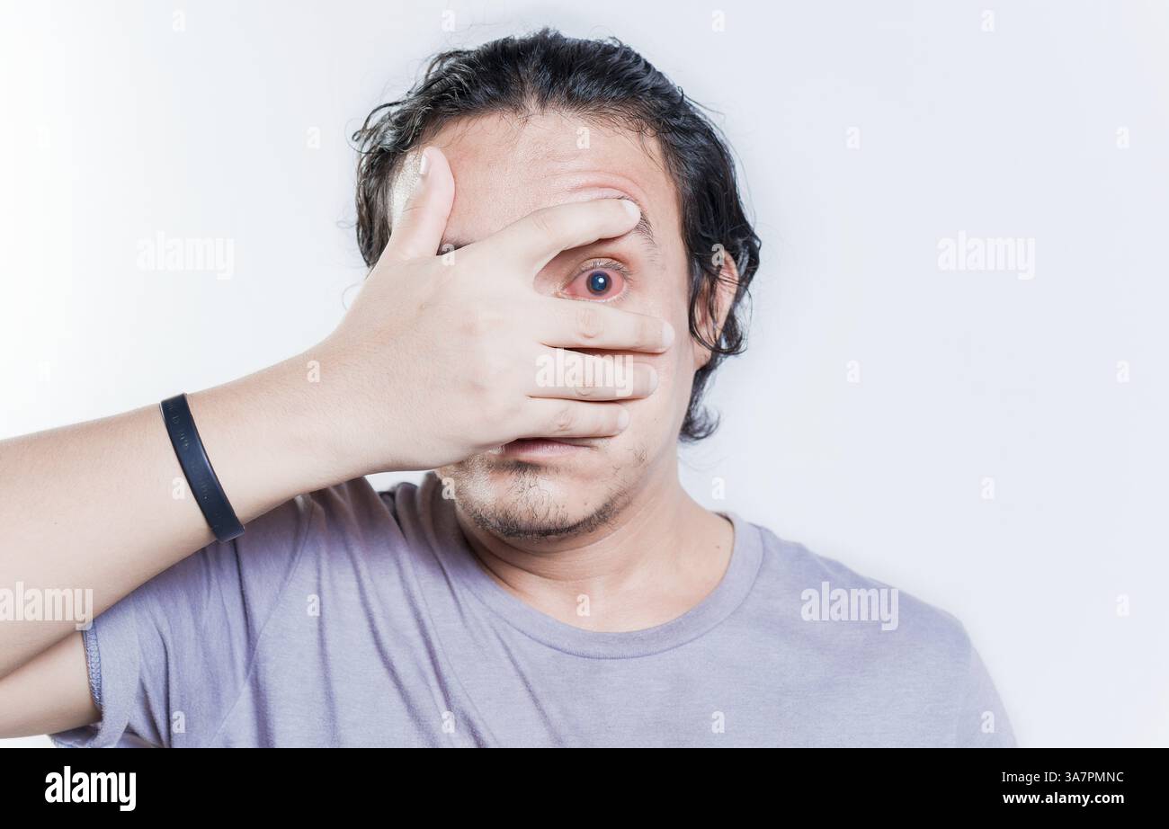 Young man with conjunctivitis isolated. People with irritated eye ...