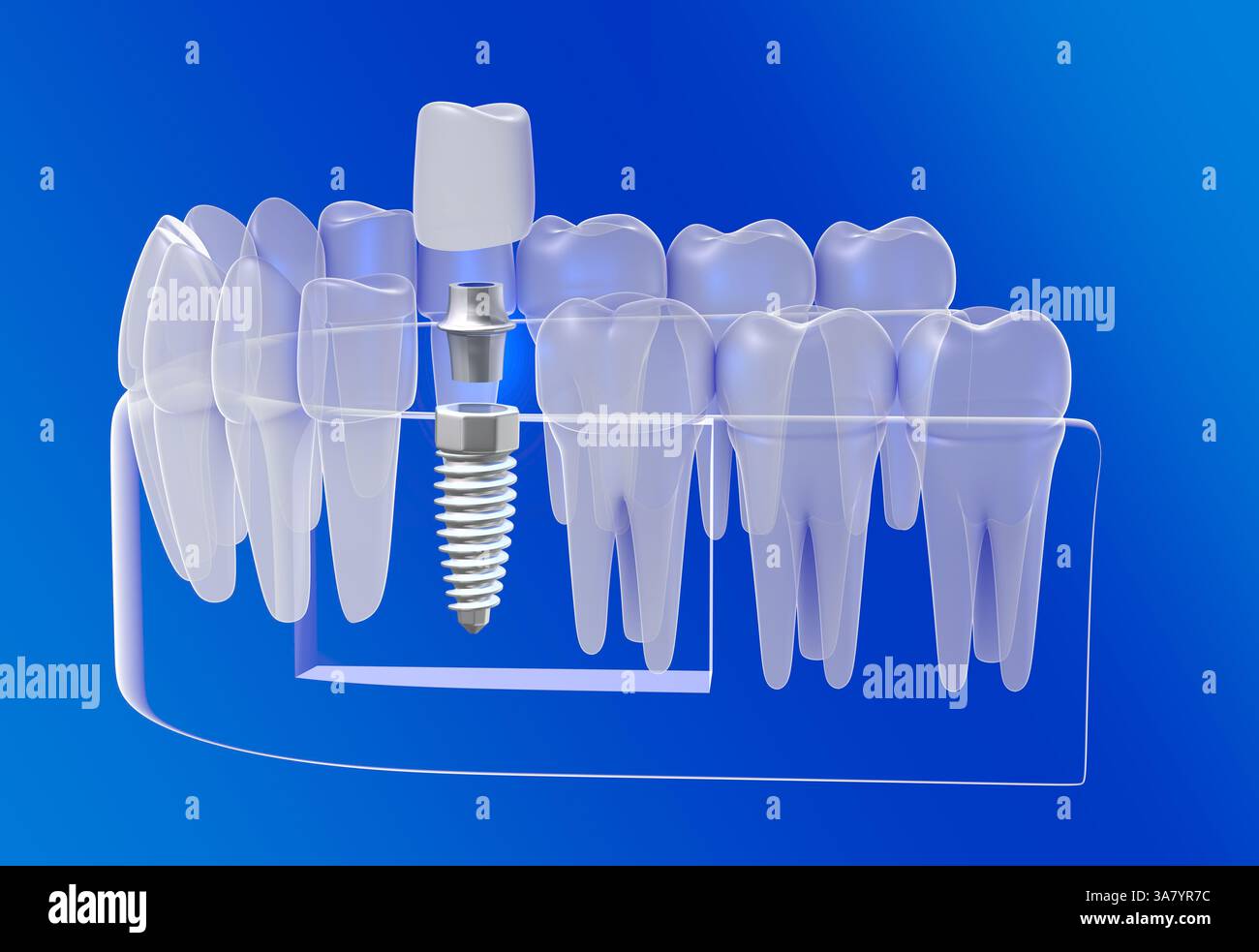 3D illustration of a dental implant in a white and transparent graphic ...
