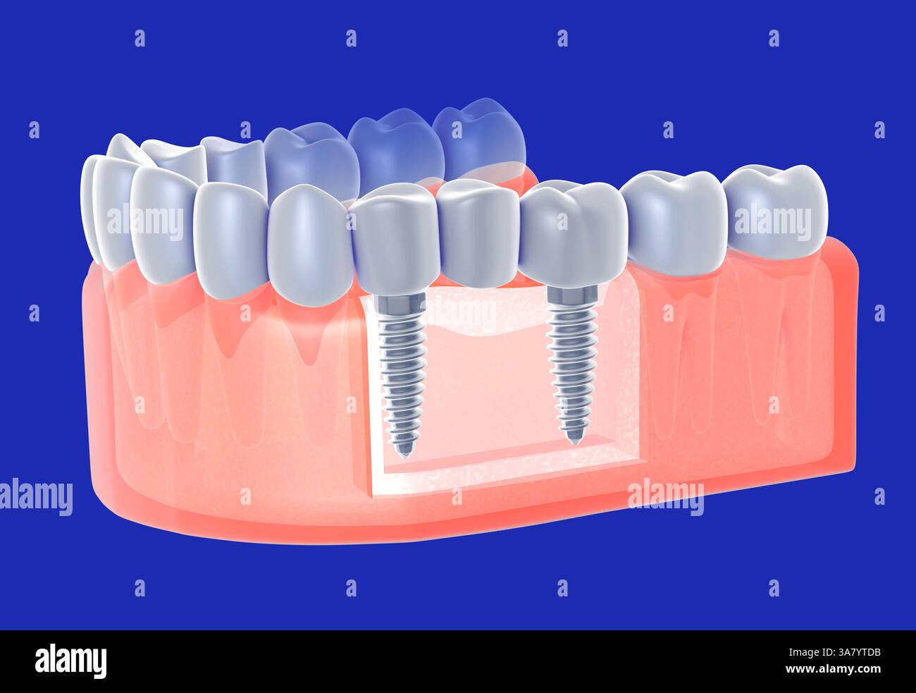 3D Illustration of a double implant being placed in a gum in a ...