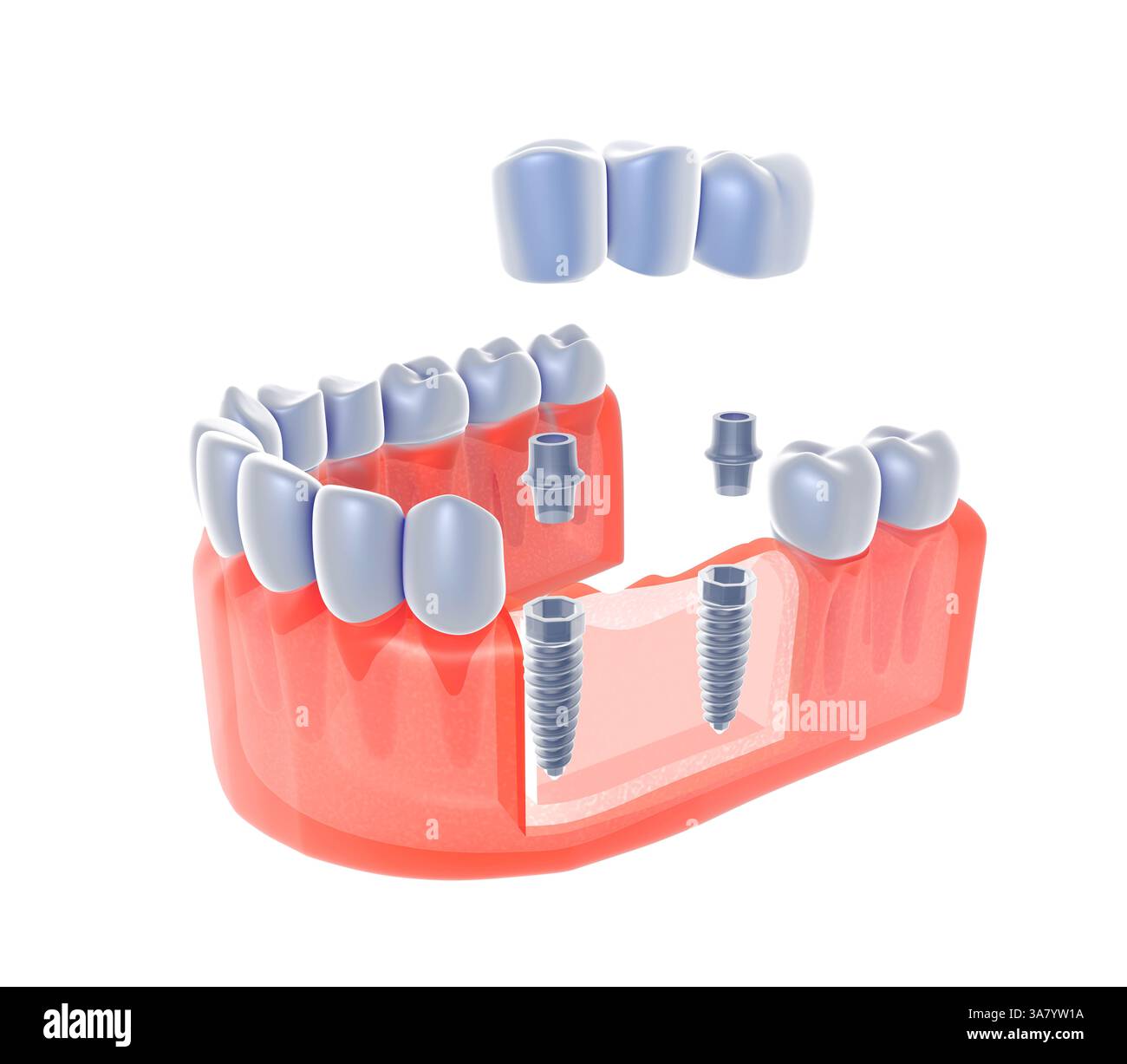 3D illustration of a double implant being placed in a gum in a ...