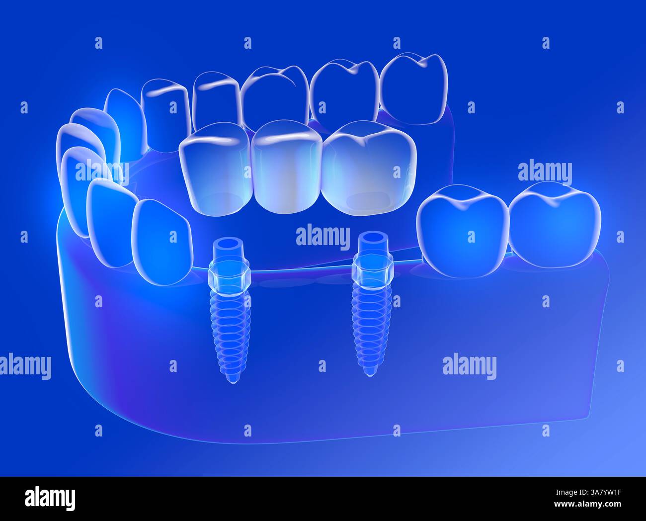 3D illustration of a double implant placed in a transparent glass gum ...
