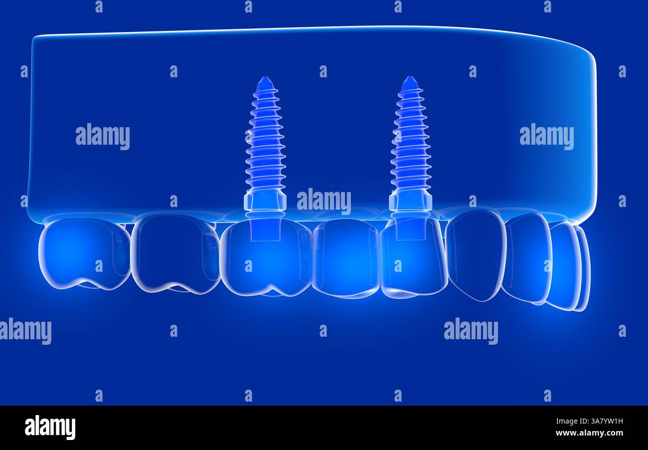 3D illustration of a double implant placed in a transparent glass gum ...