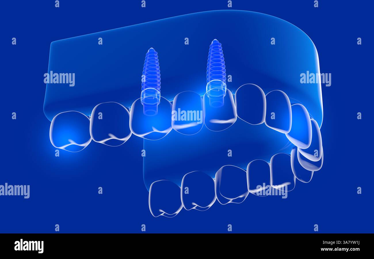 3D illustration of a double implant placed in a transparent glass gum ...