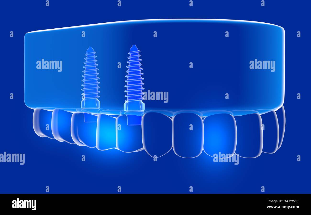 3D illustration of a double implant placed in a transparent glass gum ...