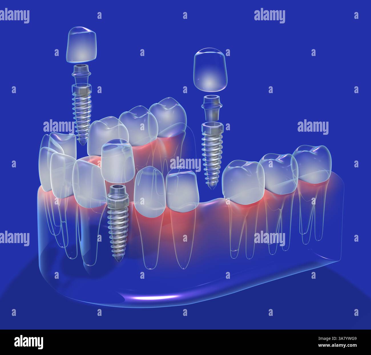 3D illustration of three implants being placed in a transparent glass ...