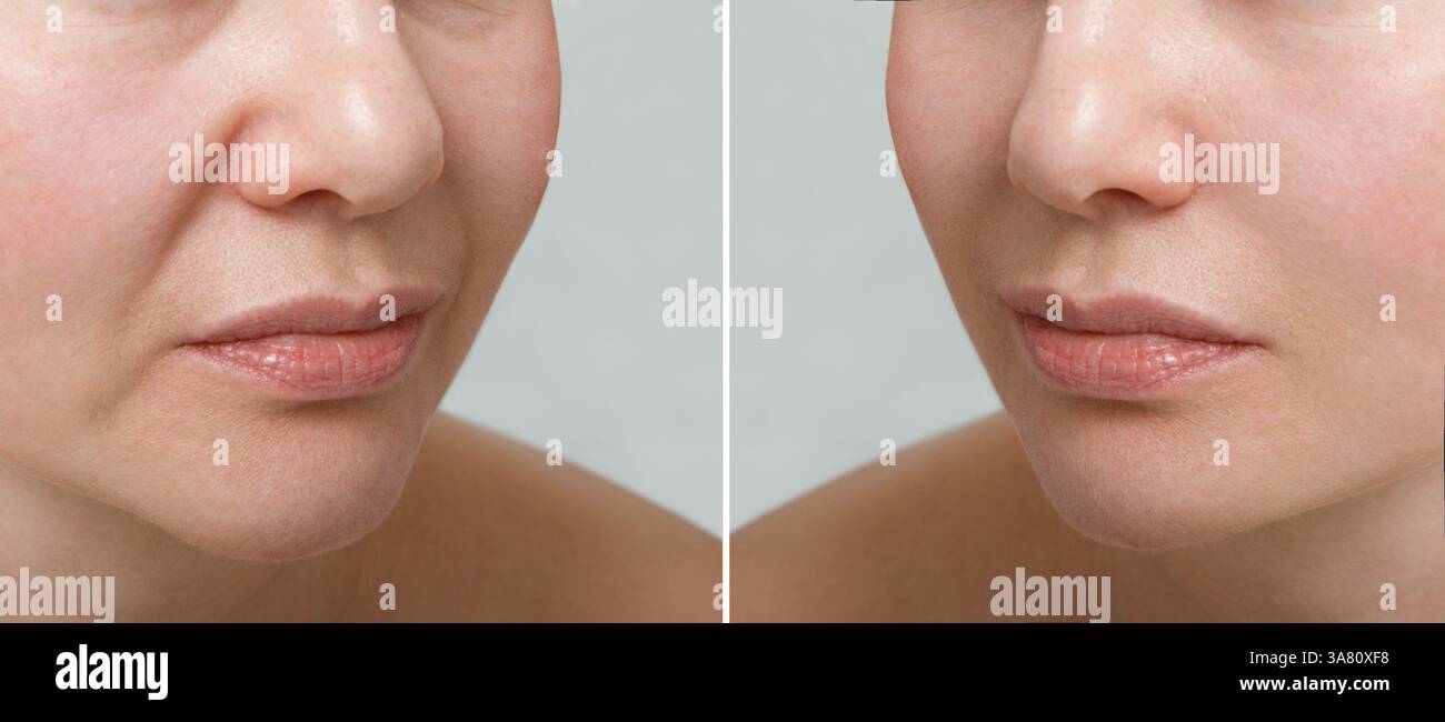 Female nasolabial fold before and after wrinkle smoothing procedures ...