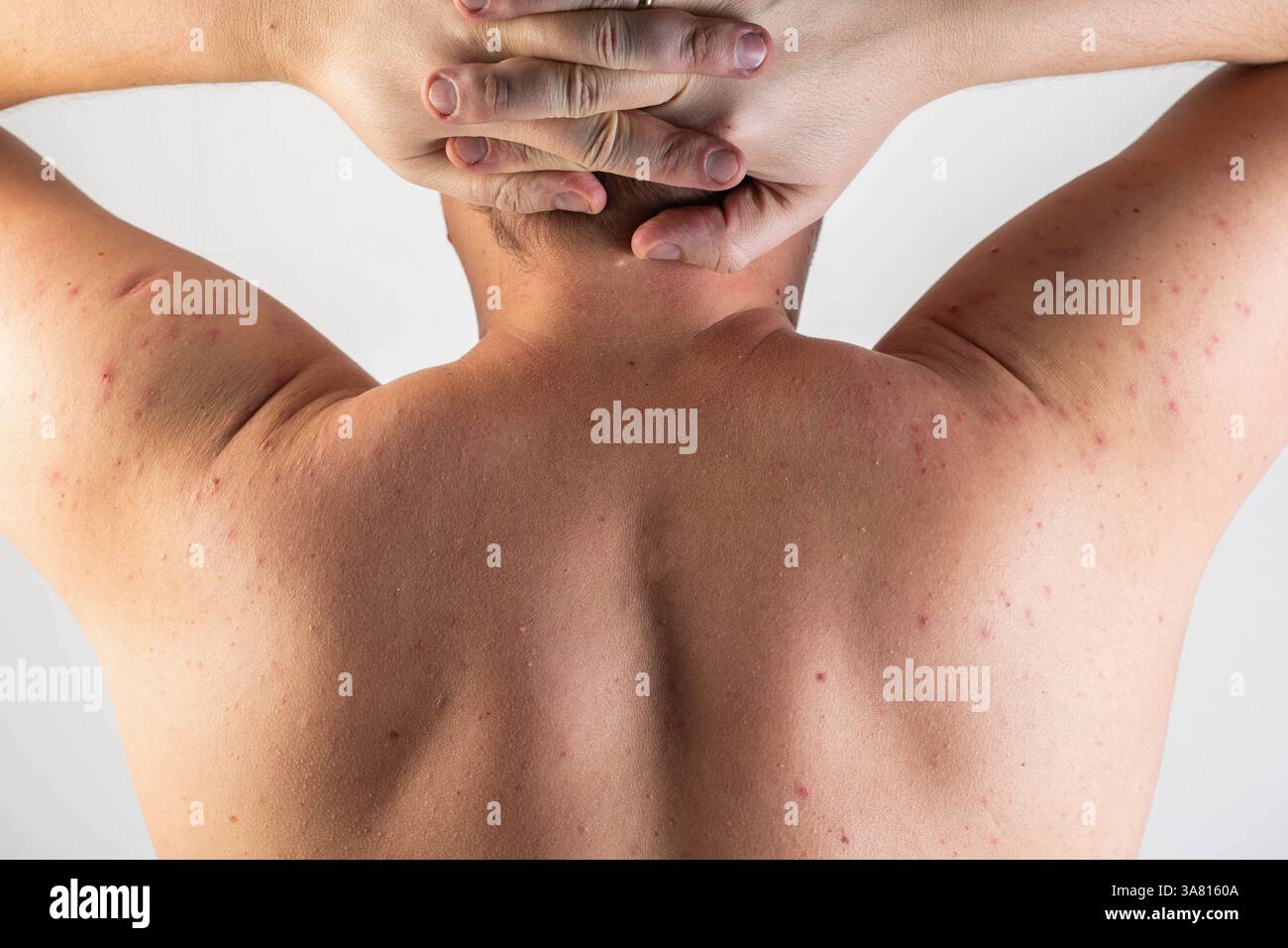 Red spots and rashes on the skin of the back and shoulders after ...