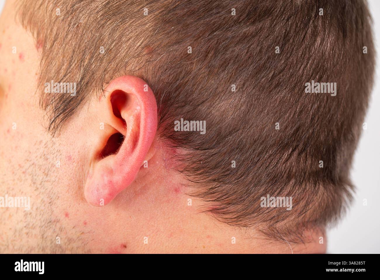Red rashes and spots on the ears and head of a man after drinking ...