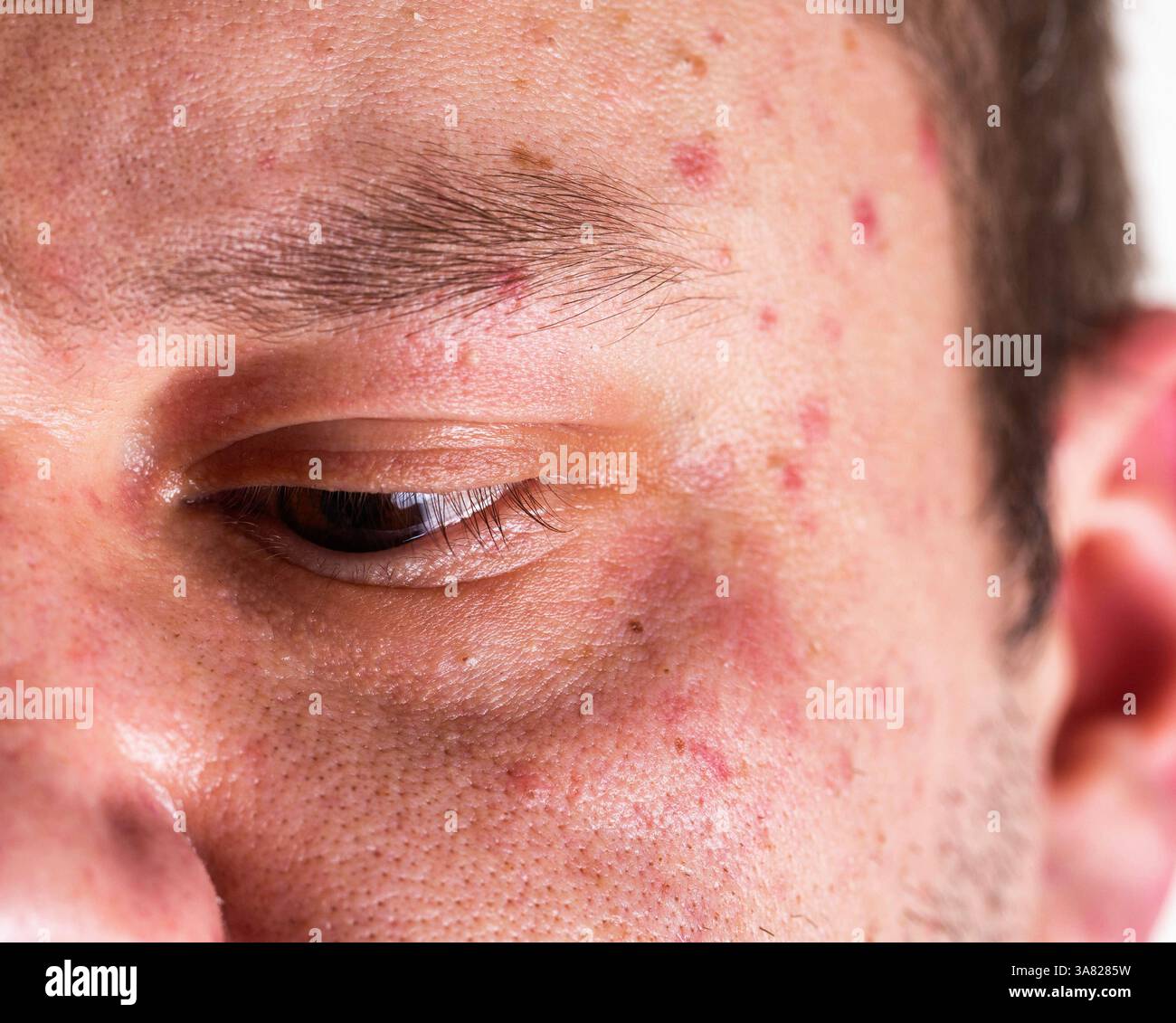 Red spots and rashes on the scalp and eyes. Alcohol intolerance ...