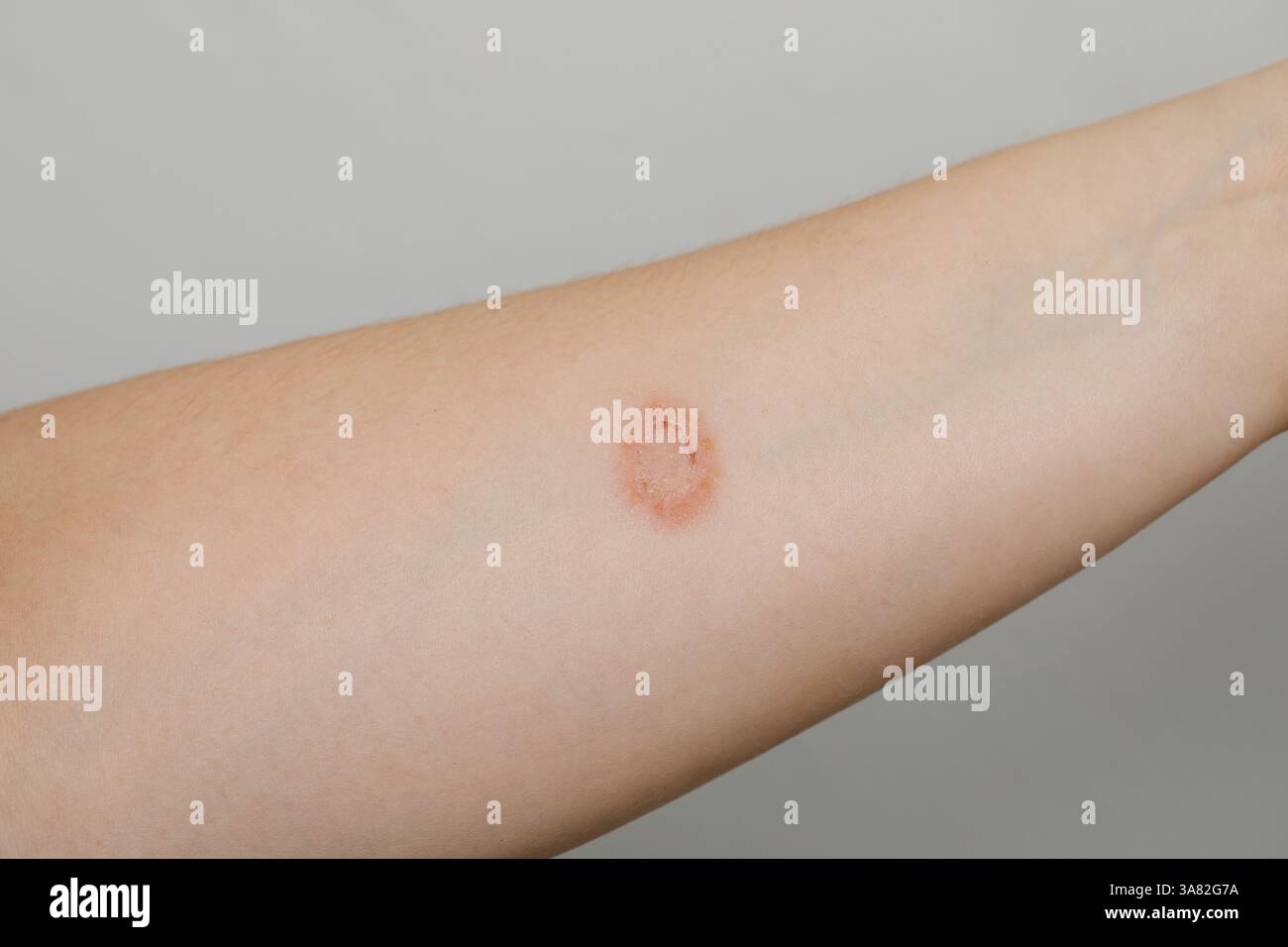 Contact Dermatitis or infection symptom on human skin Stock Photo - Alamy