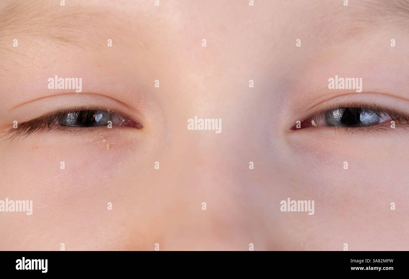 The girl has swollen, reddened, painful eyes. Inflammation of ...