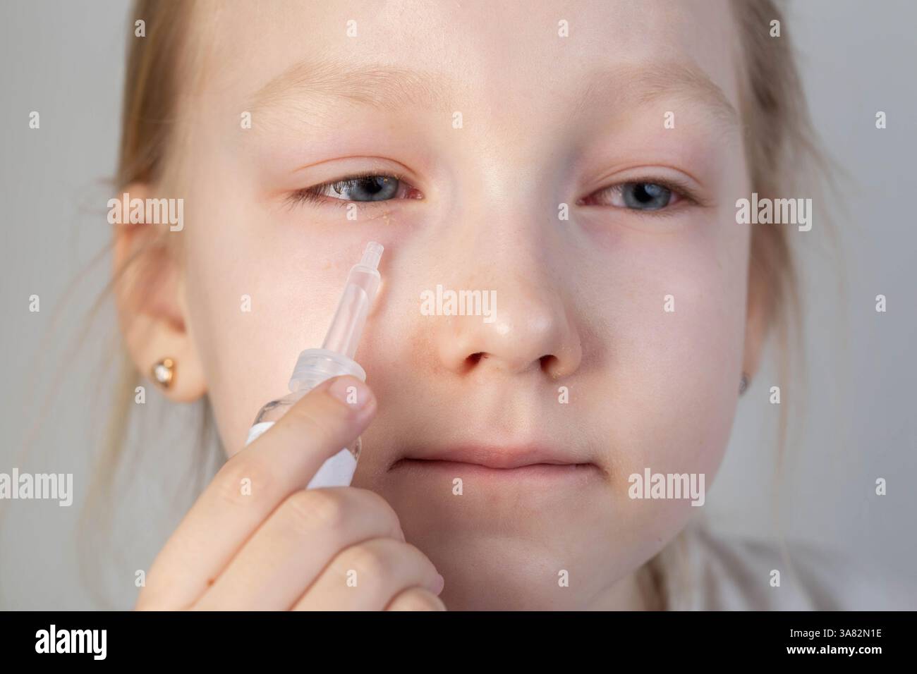 A caucasian girl holds eye drops near her face, close-up. Disease ...