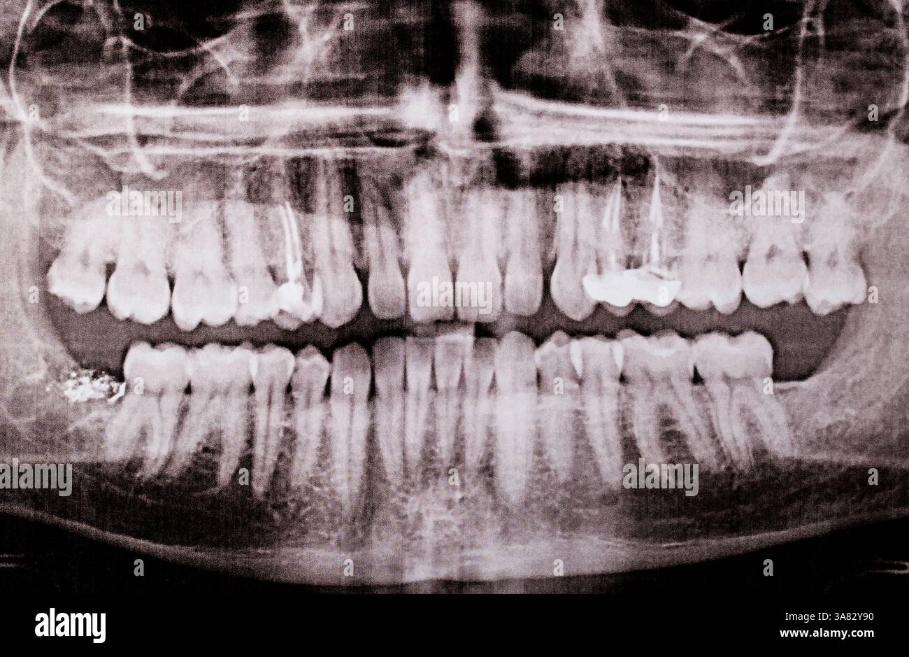X-ray of the dental jaw with removed lower wisdom teeth Stock Photo - Alamy
