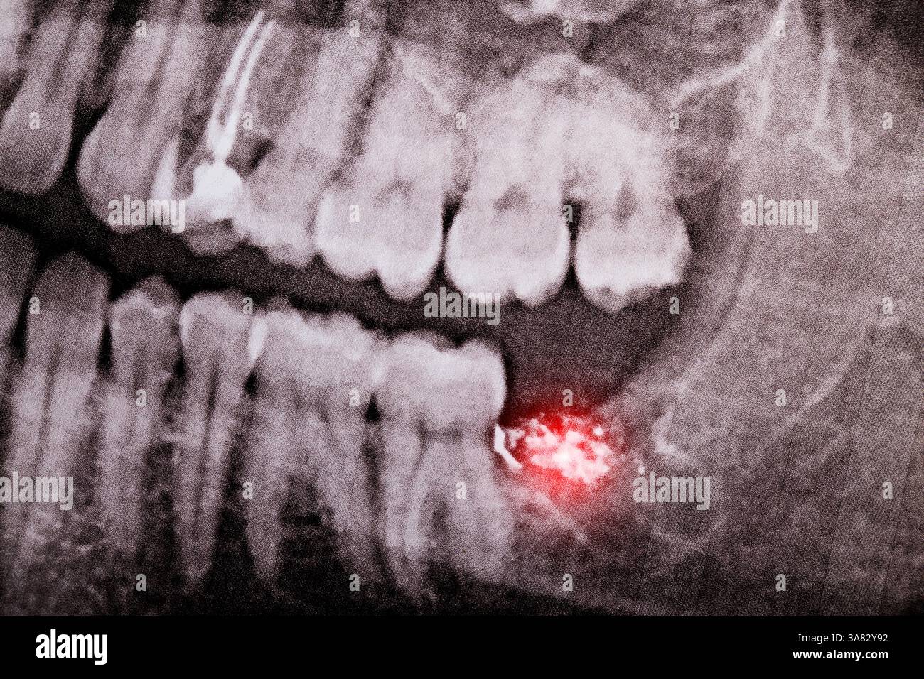Red inflamed tooth socket with medicine after wisdom tooth removal on x ...