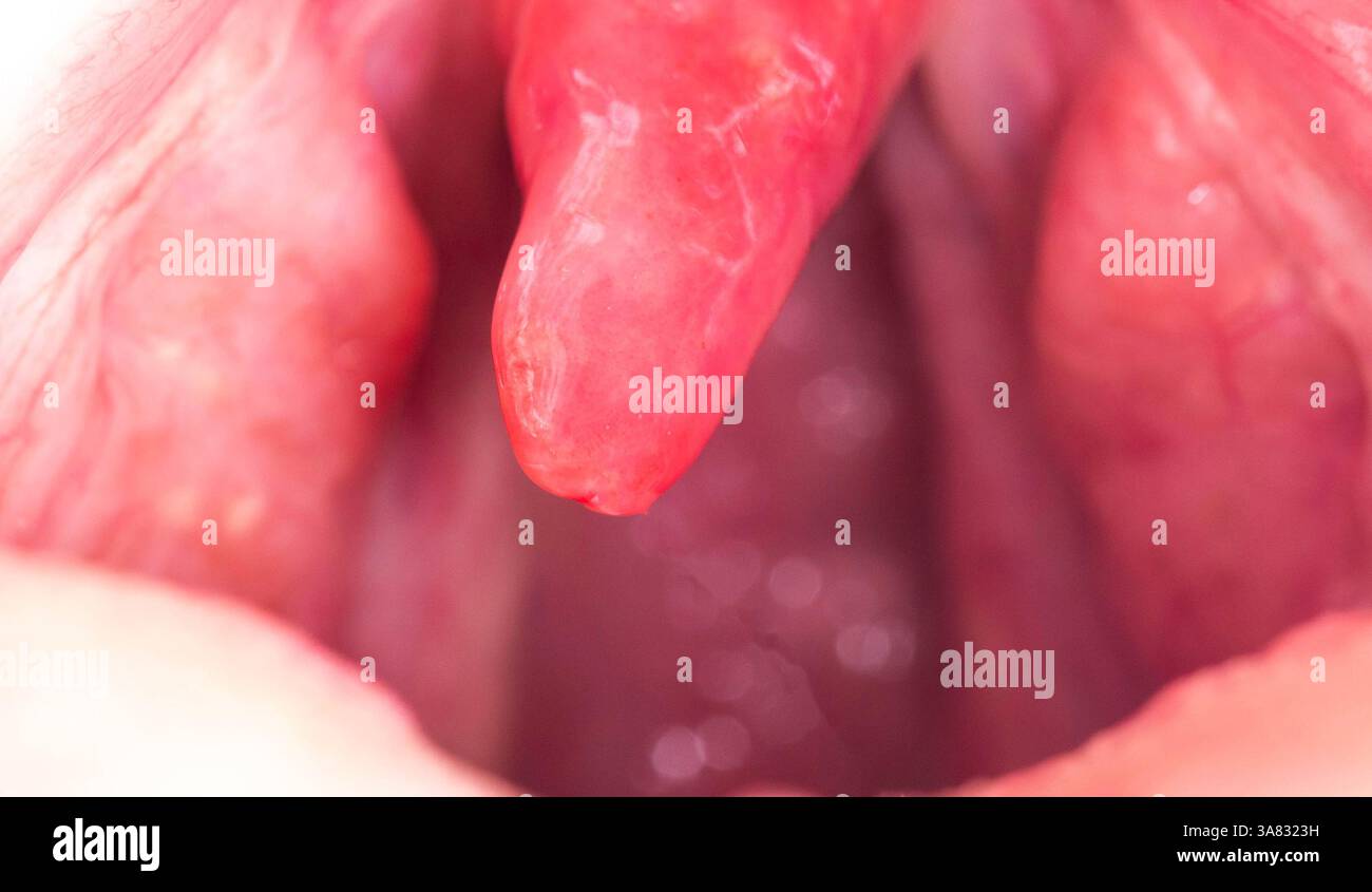 Uvulitis and sore throat in the oral cavity due to illness ...