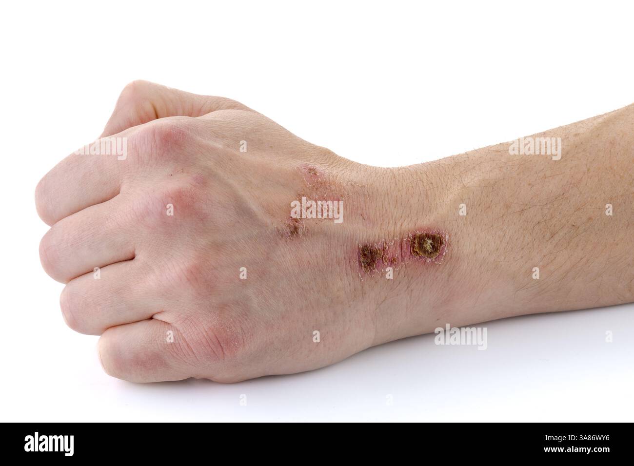 Skin abrasion hi-res stock photography and images - Alamy