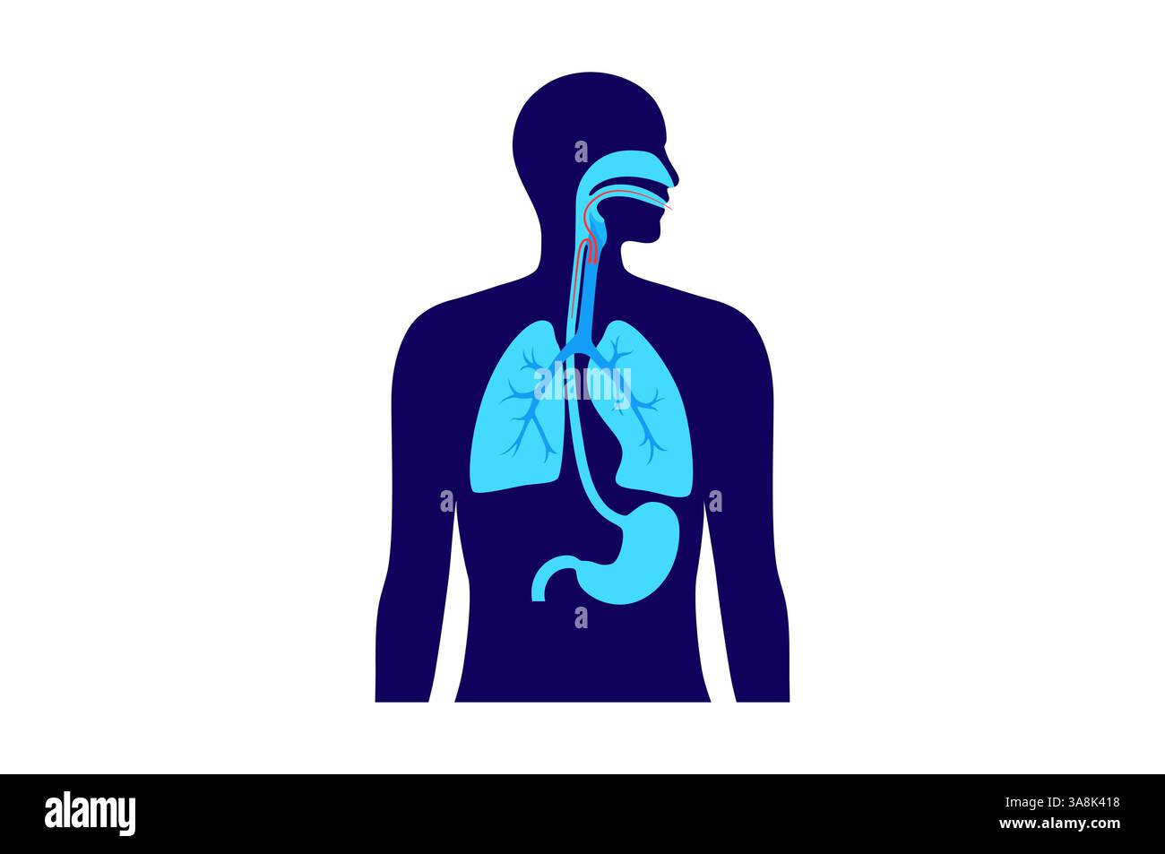 Aspiration pneumonia, illustration. Aspiration pneumonia is a lung ...