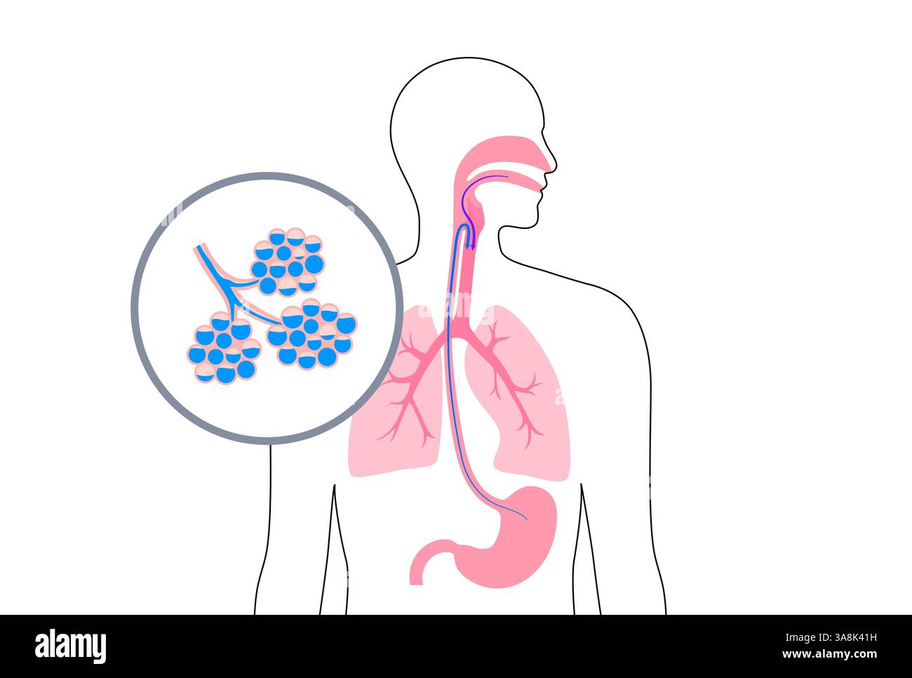 Aspiration pneumonia, illustration. Aspiration pneumonia is a lung ...