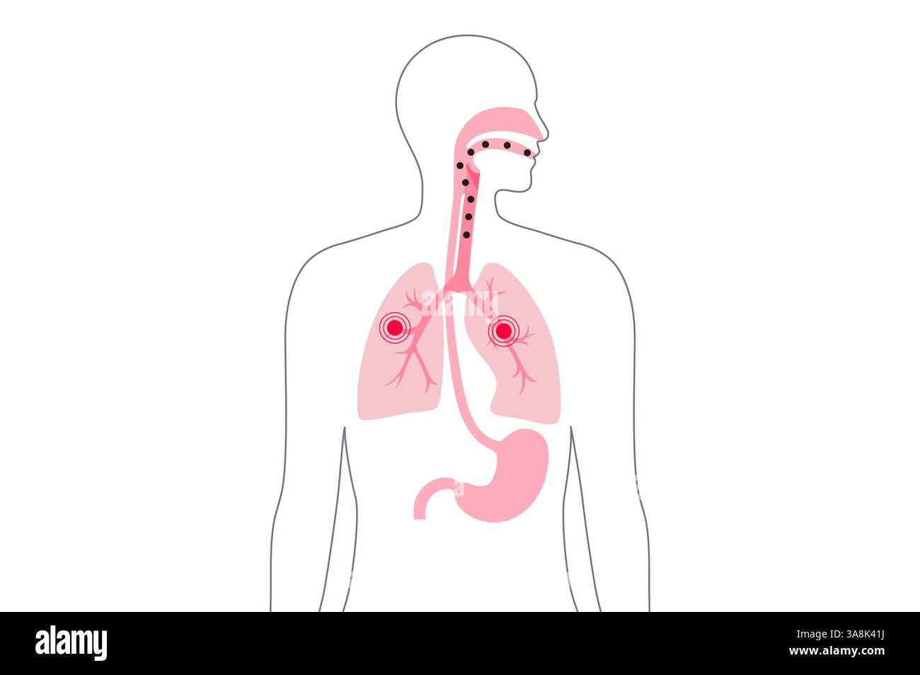 Dysphagia related aspiration pneumonia hi-res stock photography and ...