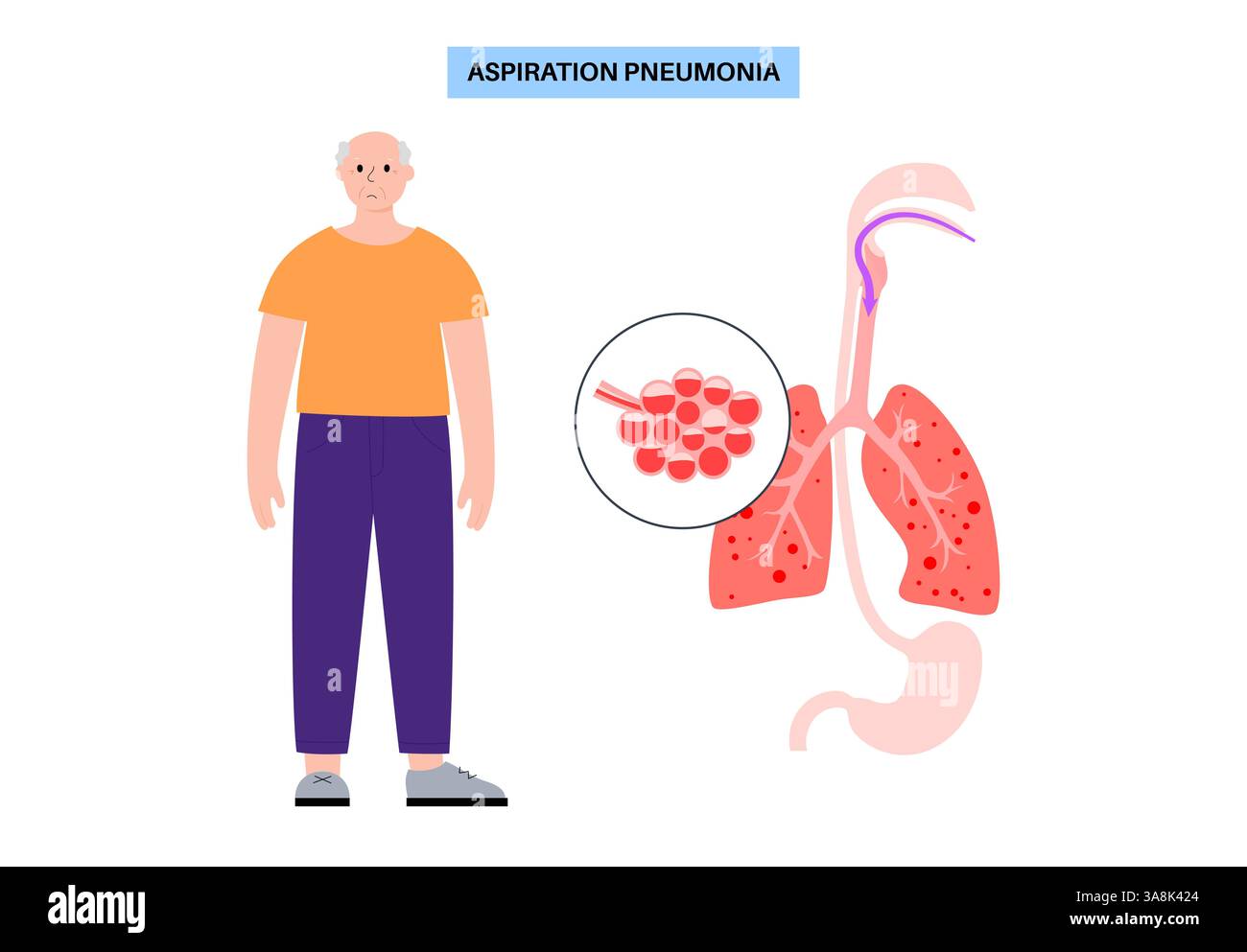 Dysphagia related aspiration pneumonia hi-res stock photography and ...