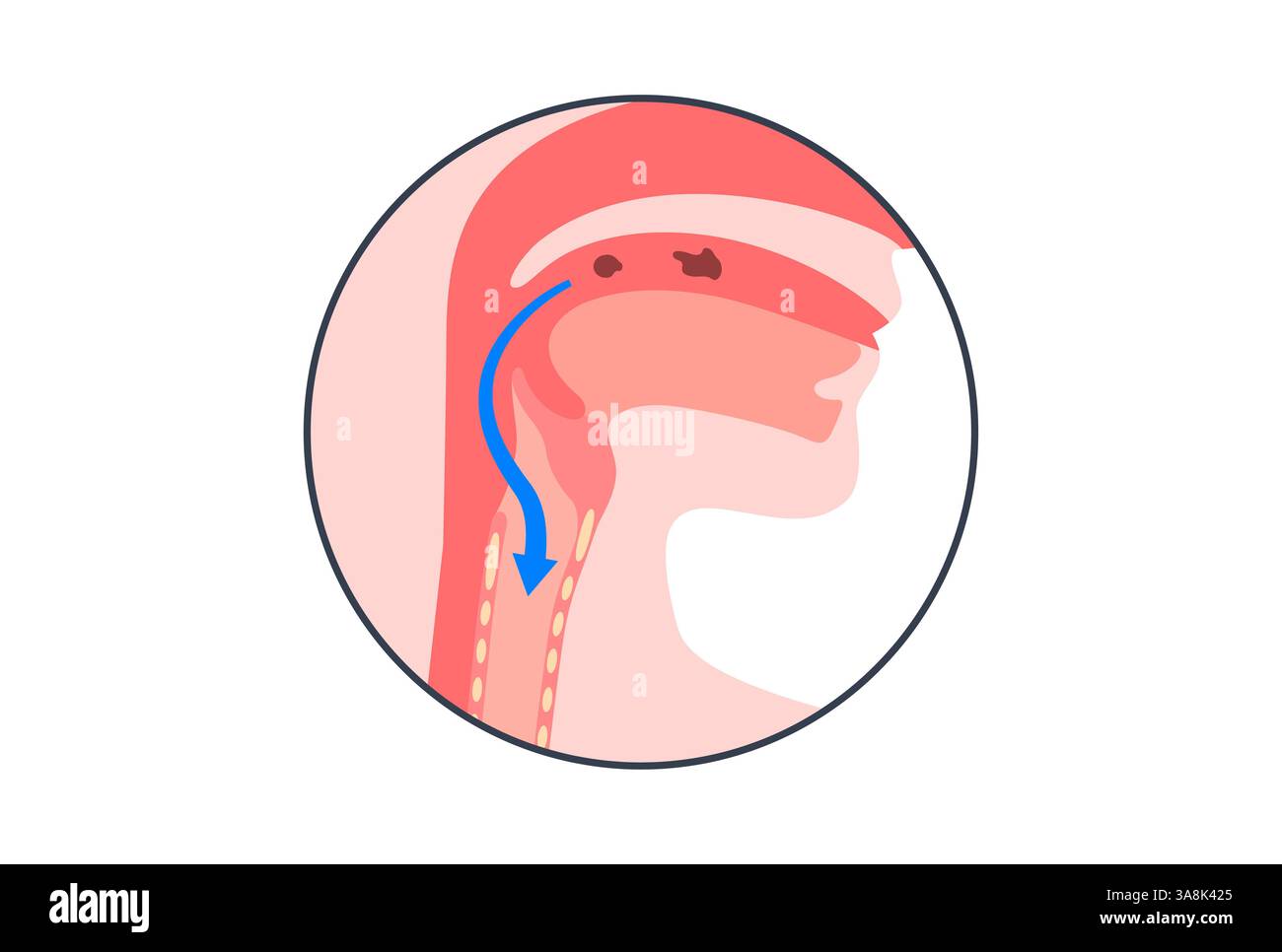 Dysphagia related aspiration pneumonia Cut Out Stock Images & Pictures ...