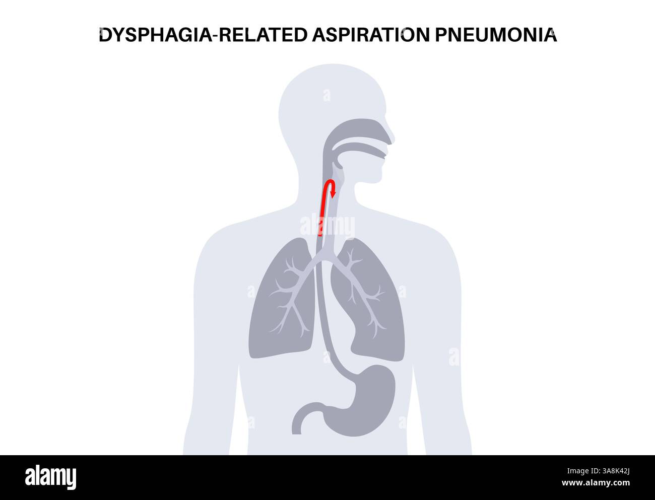 Dysphagia-related aspiration pneumonia, illustration. Aspiration ...