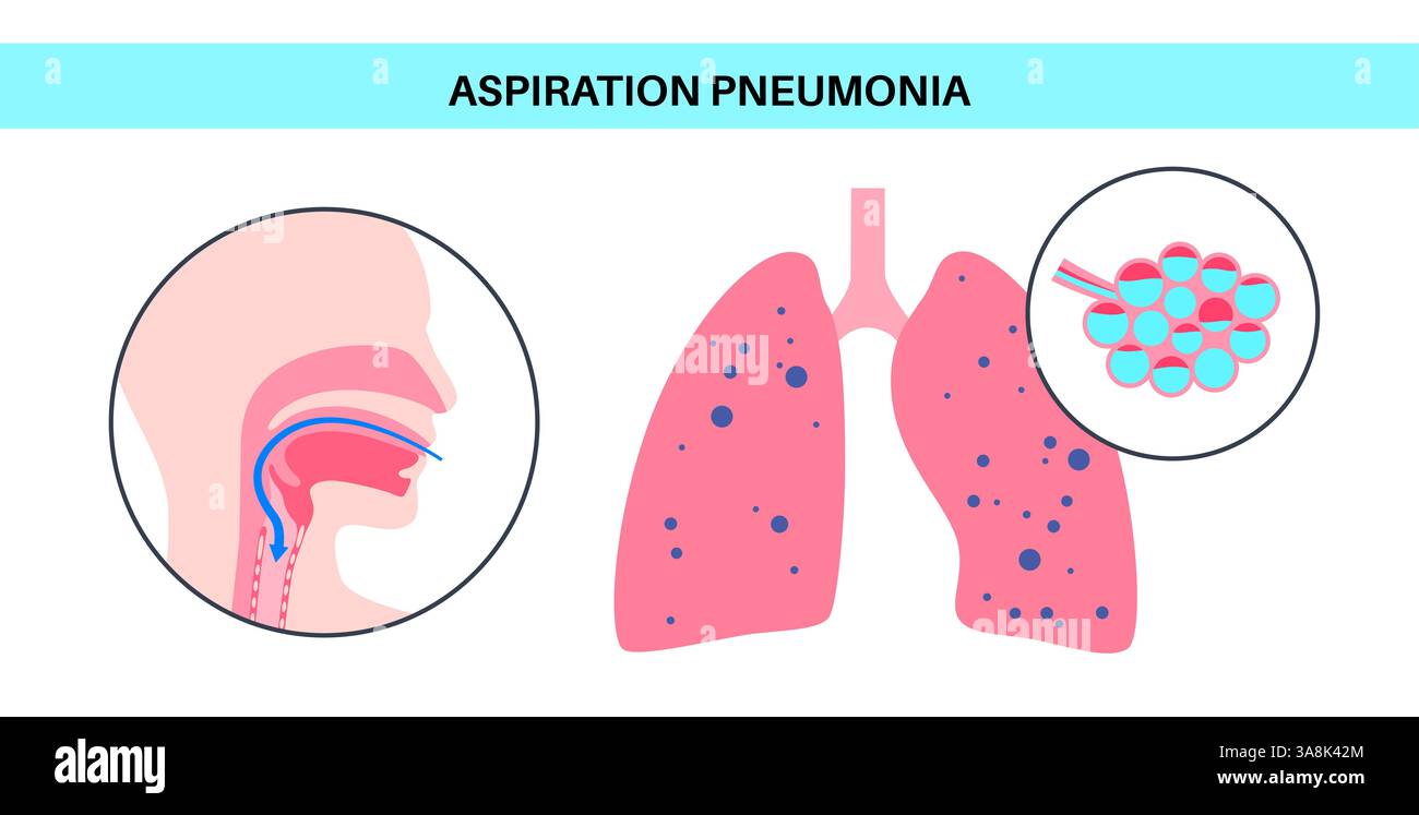 Aspiration pneumonia, illustration. Aspiration pneumonia is a lung ...