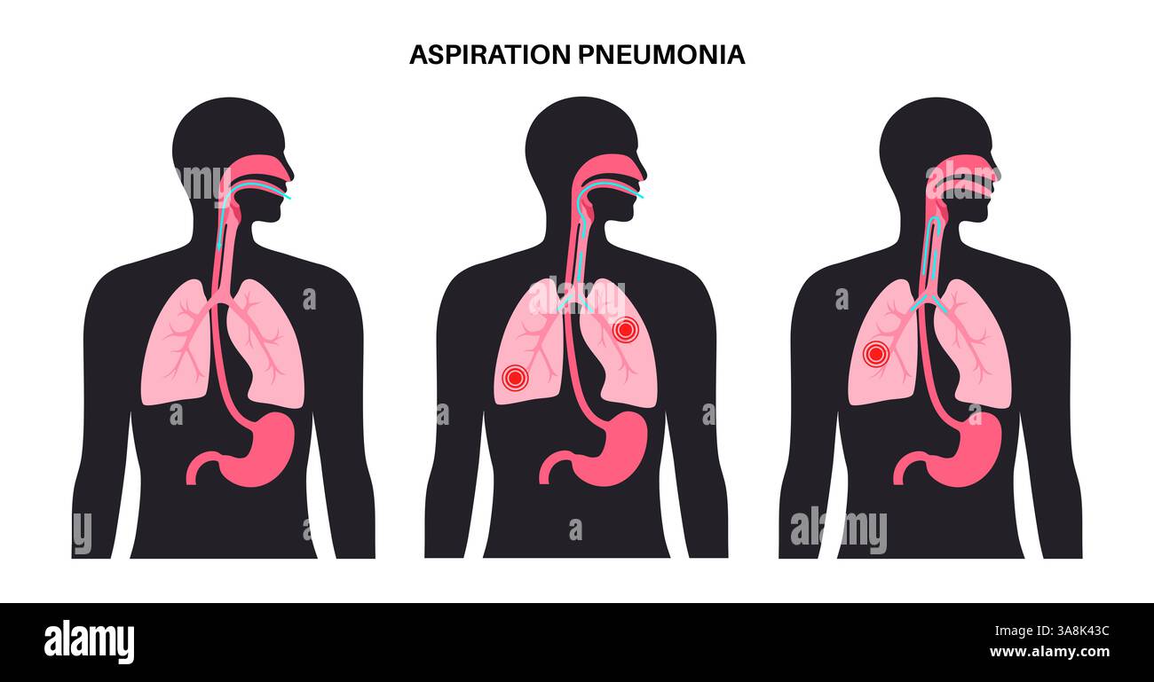 Aspiration pneumonia, illustration. Aspiration pneumonia is a lung ...