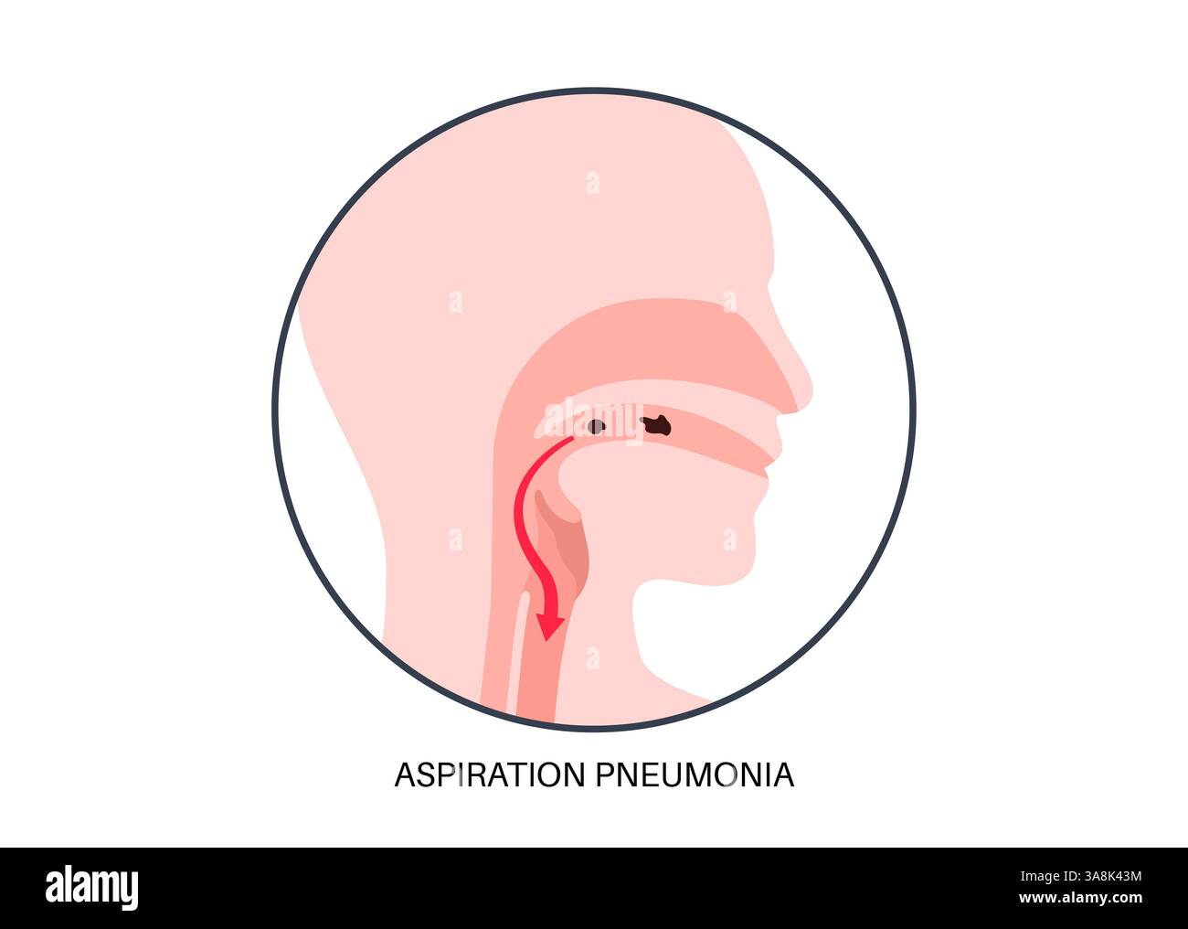 Aspiration pneumonia, illustration. Aspiration pneumonia is a lung ...