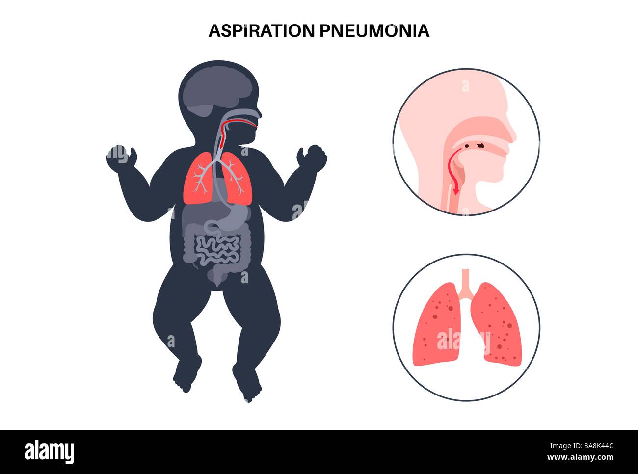 Aspiration pneumonia in a baby, illustration. Aspiration pneumonia is a ...