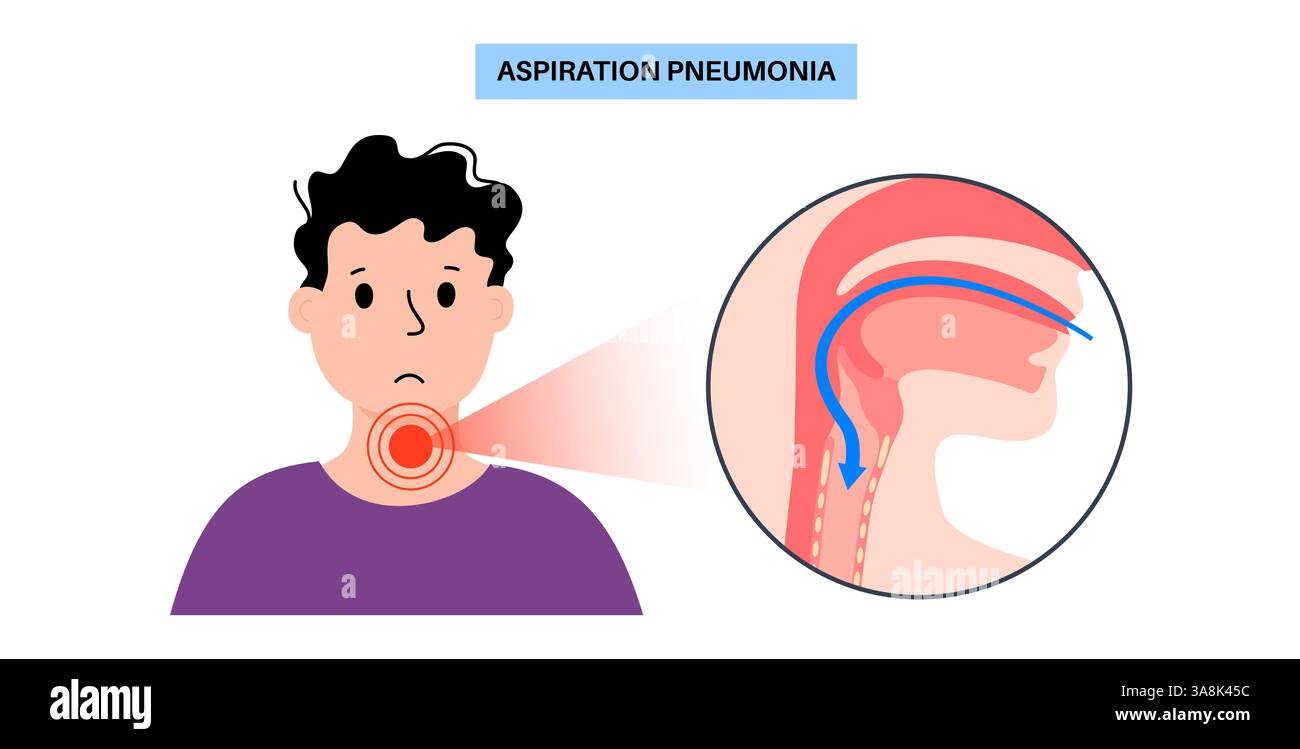 Aspiration pneumonia, illustration. Aspiration pneumonia is a lung ...