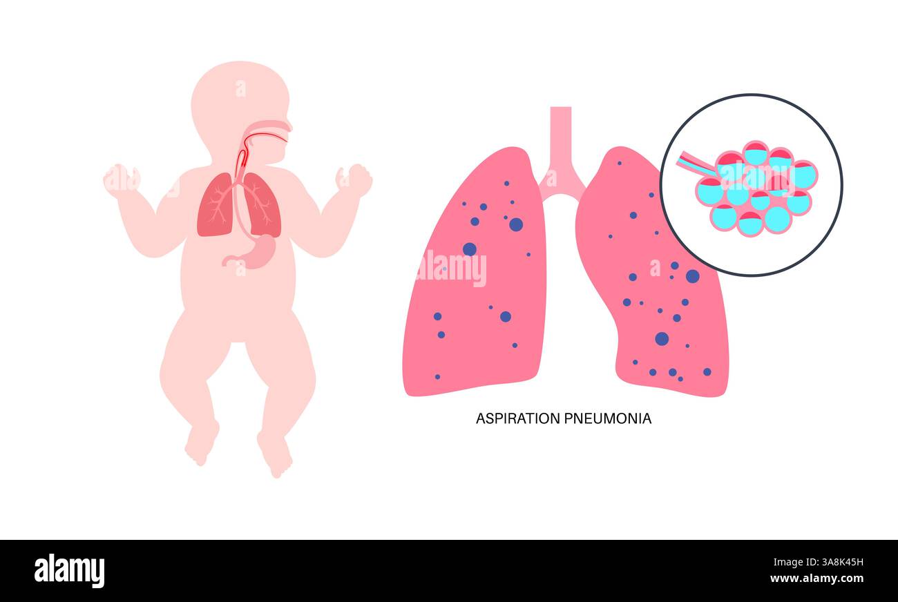 Aspiration pneumonia in a baby, illustration. Aspiration pneumonia is a ...