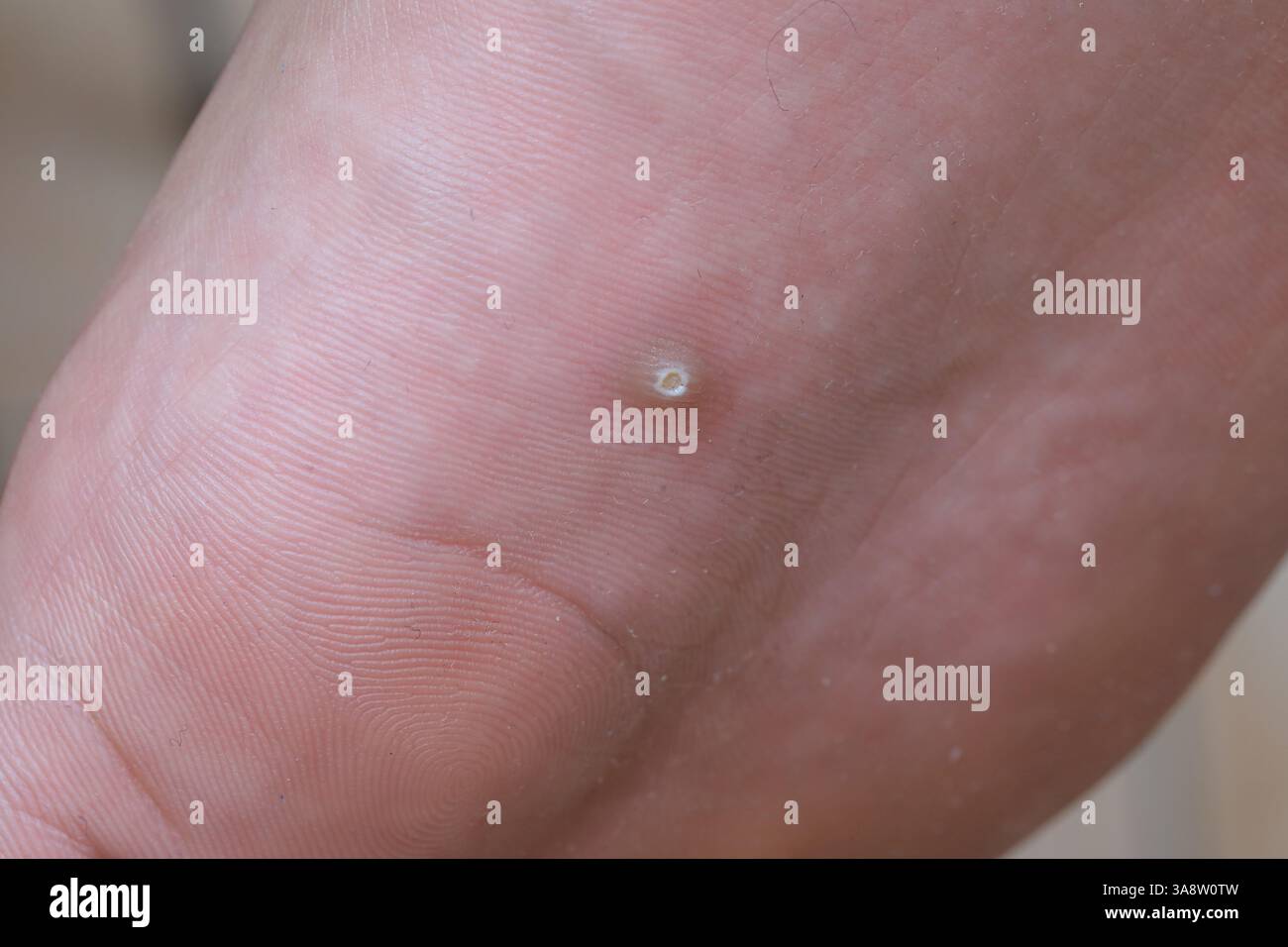 Close-up of a plantar wart, a common skin condition affecting the feet ...