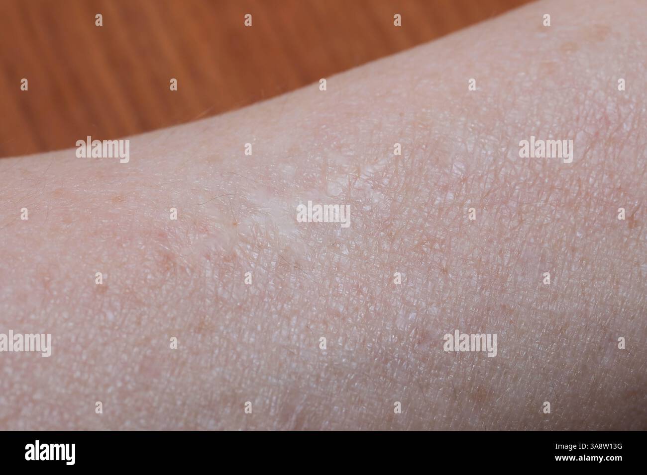 Goosebumps appearing on dry skin, possibly indicating a skin condition ...