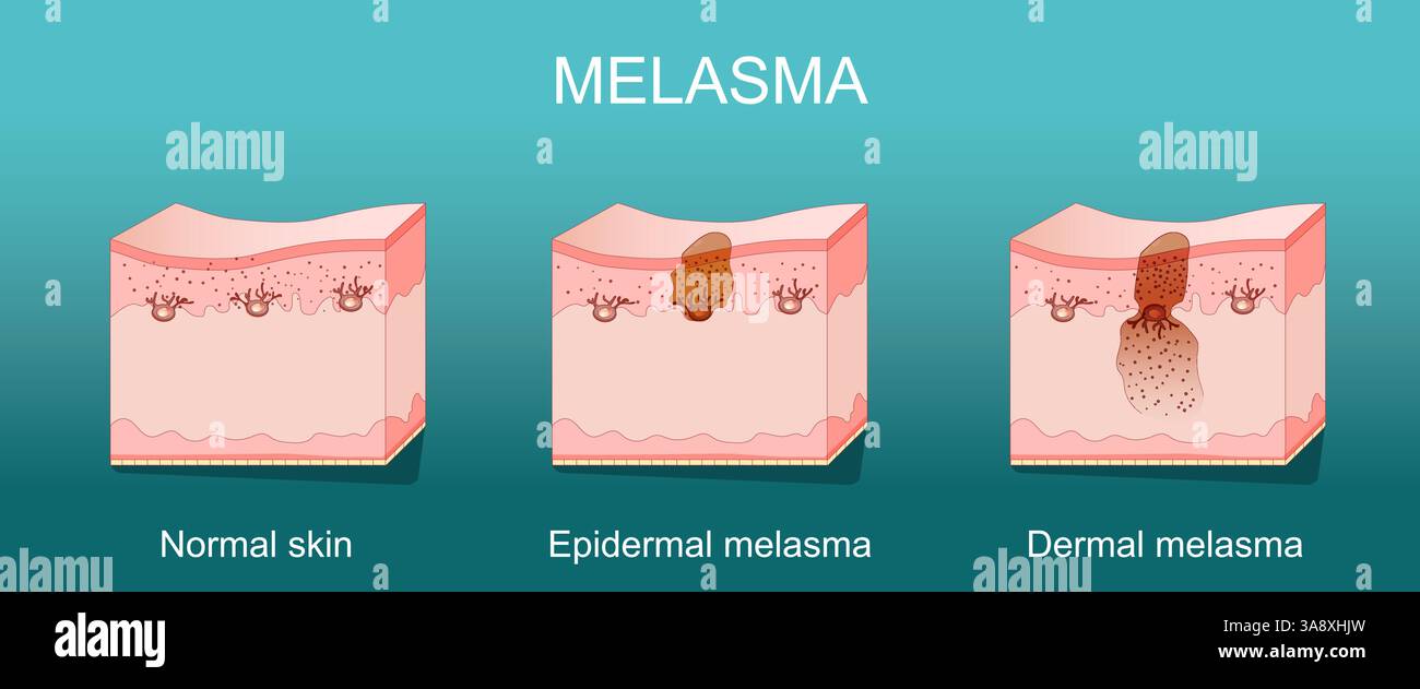 Melasma. Types of chloasma faciei. Cross section of human skin with ...