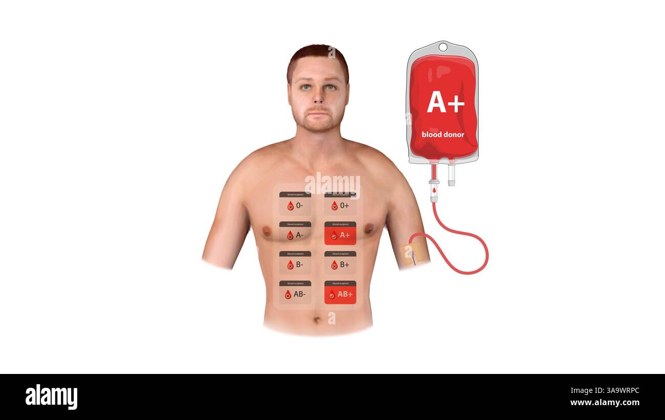 A medical illustration of an A Positive donor, showing transfusion ...