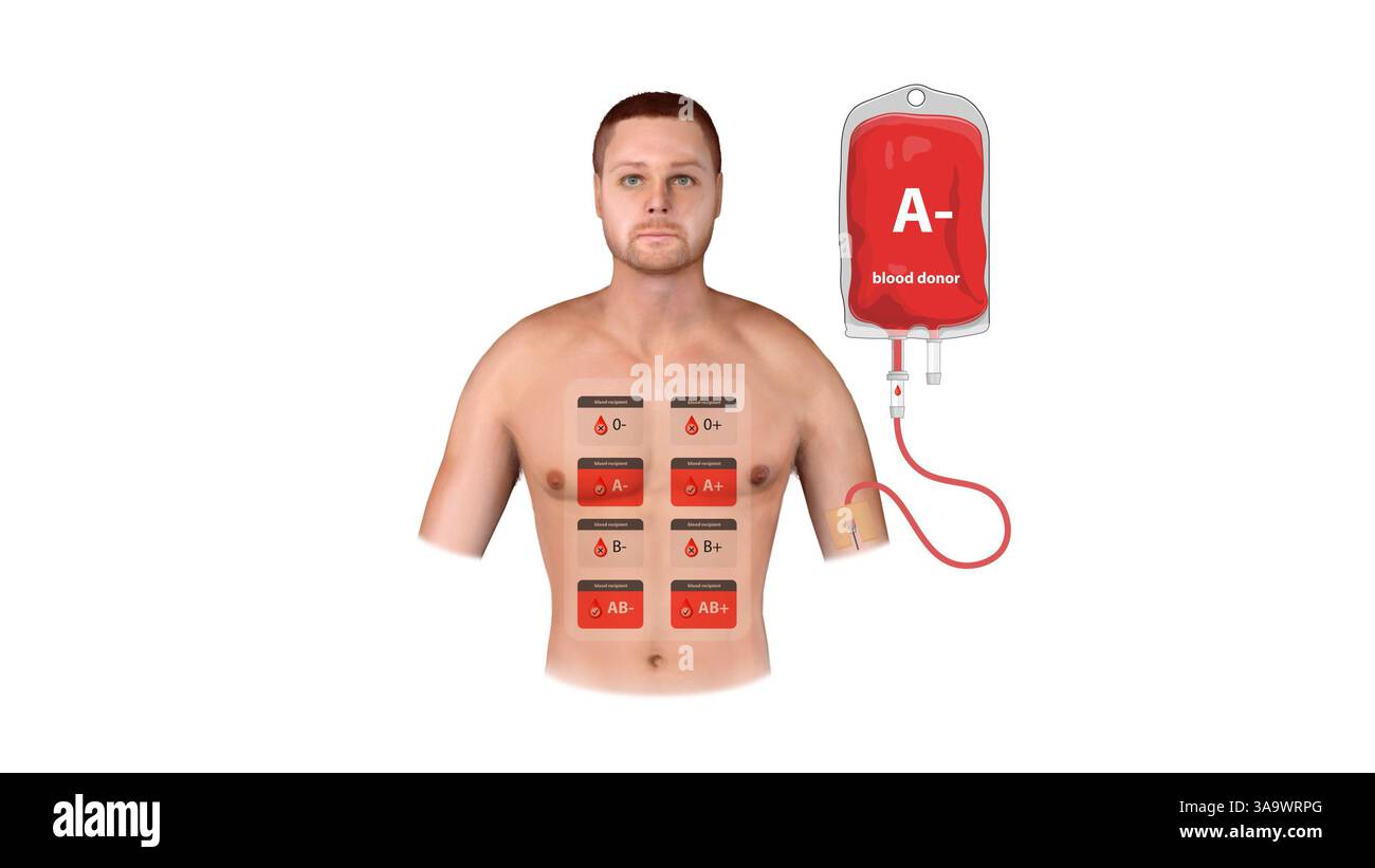 A medical illustration of an A Negative donor, showing transfusion ...