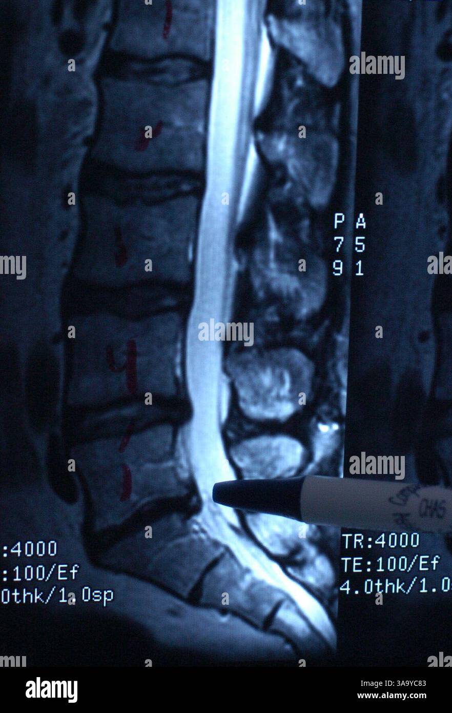 A pen is used to point out the section of the spinal cord that is being ...