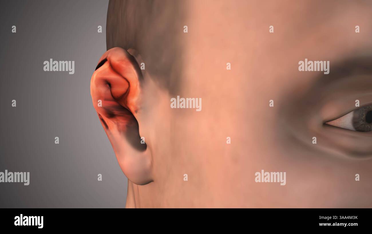 Swollen Ear Anatomy with Auricular Abscess Stock Photo - Alamy