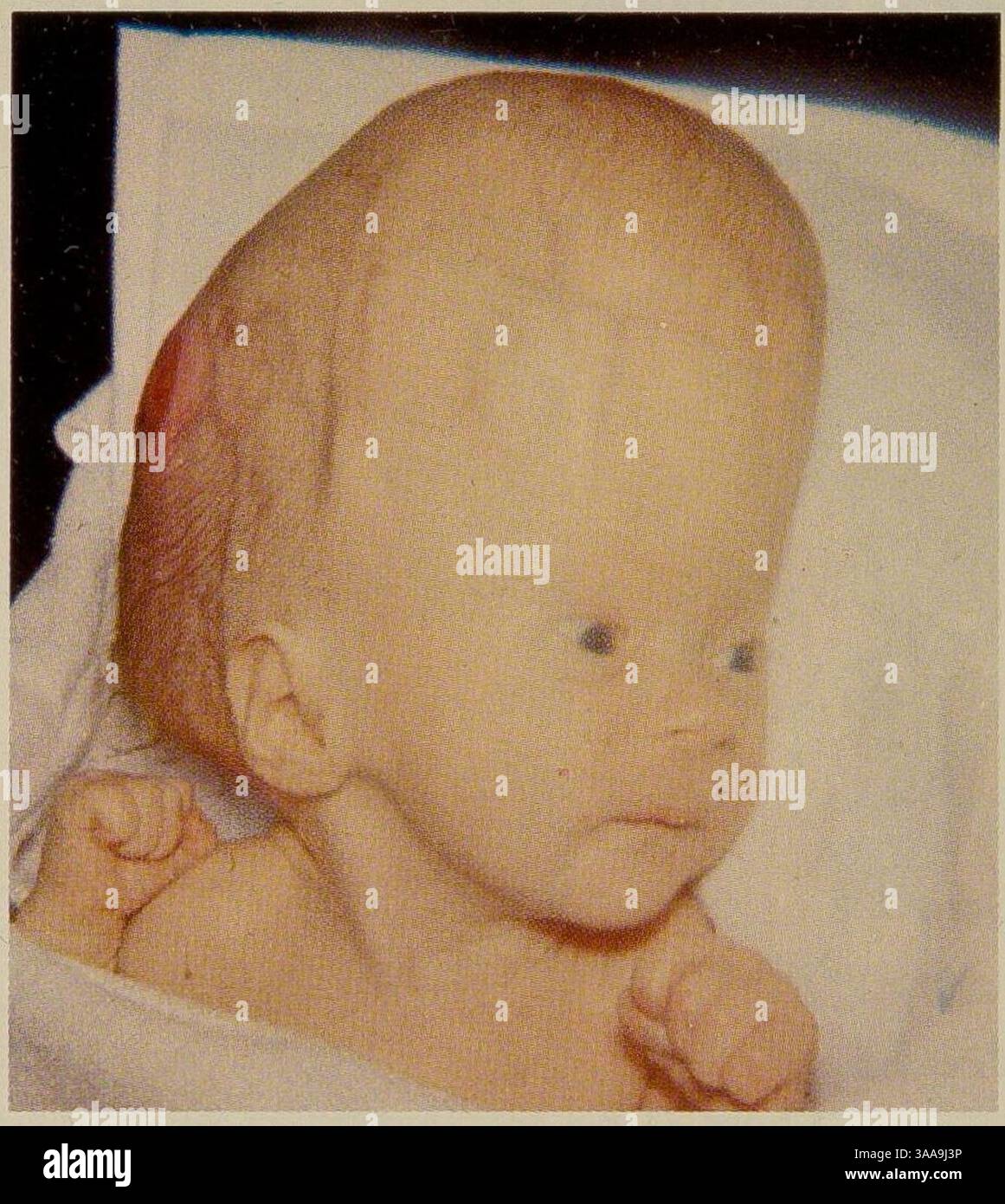 Hydrocephalus, Congenital 2 Stock Photo - Alamy