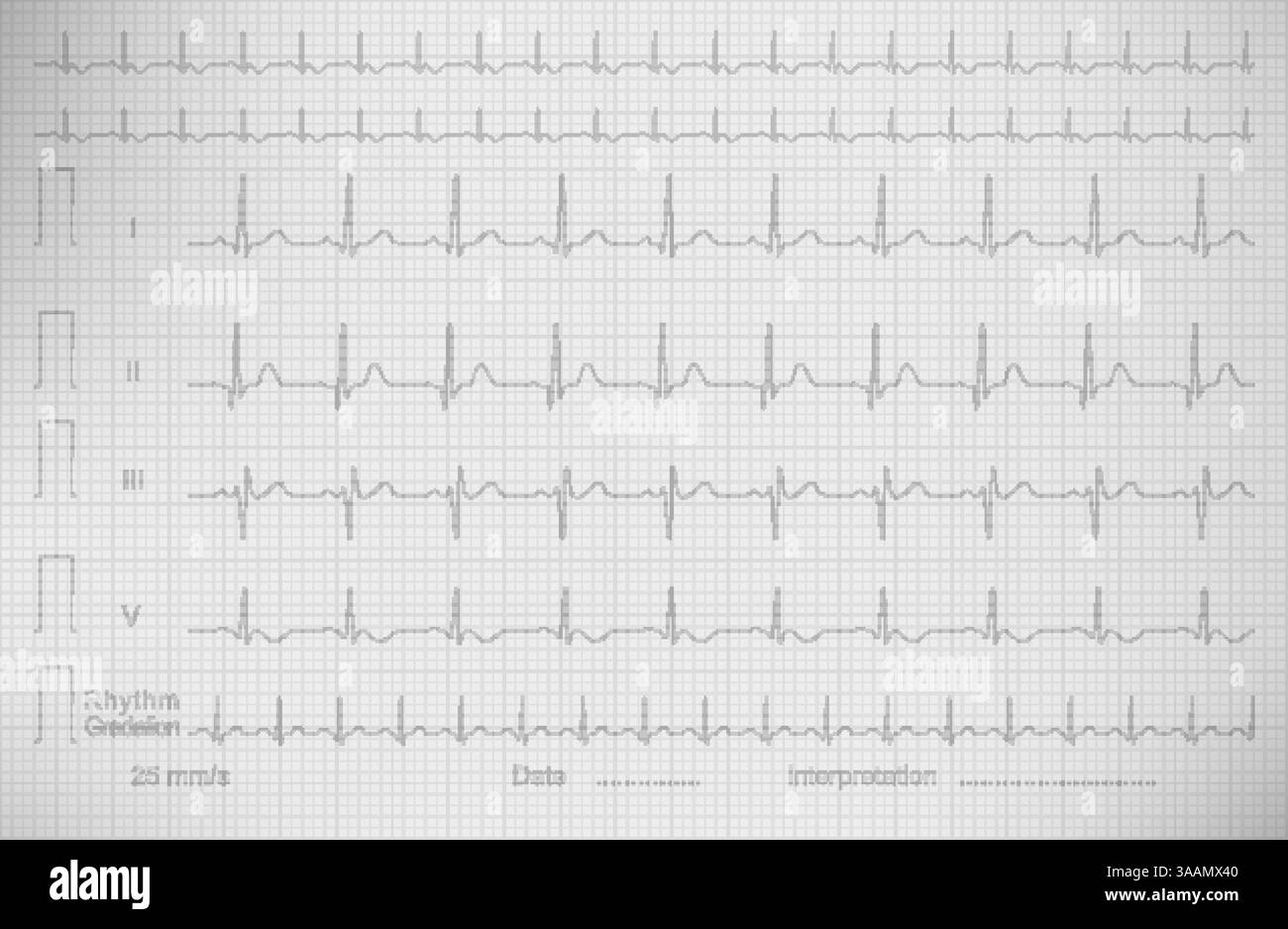ECG drawing on the square paper, vector image Stock Vector Image & Art ...