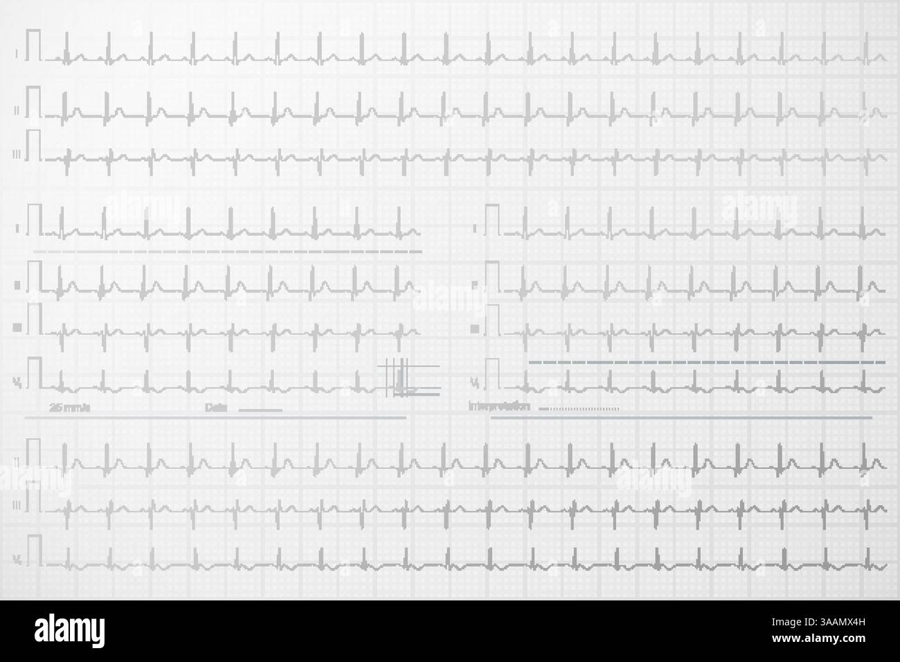 ECG lines on the paper background, vector illustration Stock Vector ...