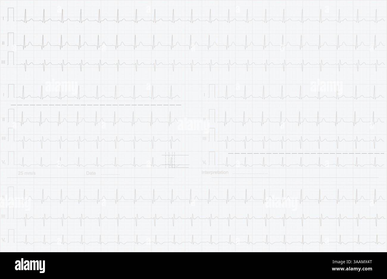 ECG lines background, medical science vector illustration Stock Vector ... ECG lines background, medical science vector illustration Stock Vector ...