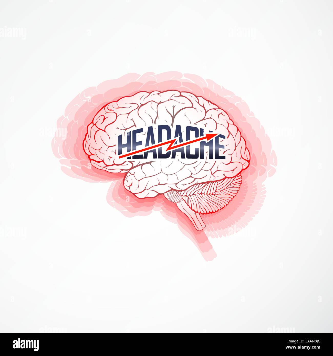 Headache concept depicting inflamed brain disease. Vector illustration ...