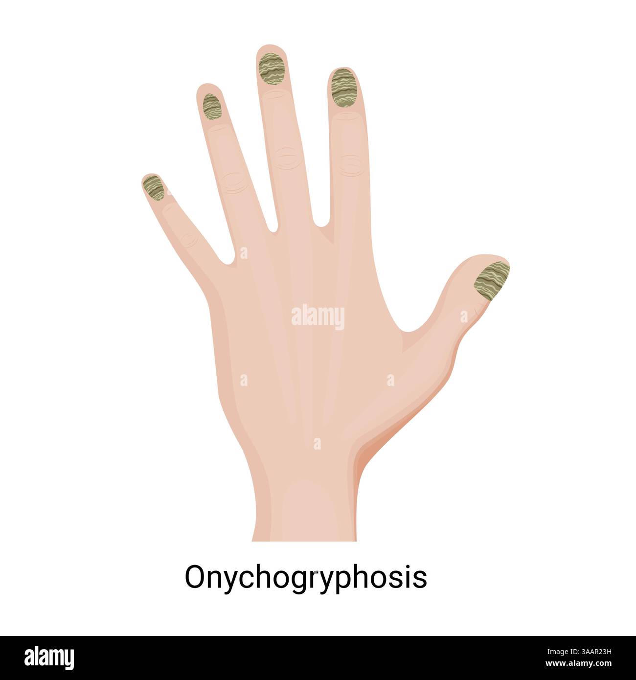 Fingernail onychogryphosis, nail pathology, Ram Horn Nails on hand ...