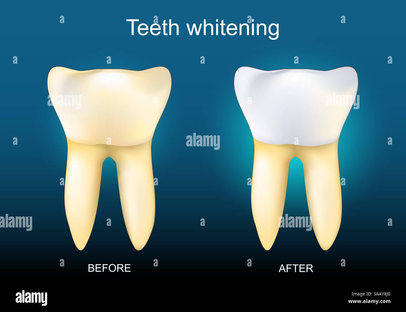 Teeth whitening. Tooth before and after procedure Dental bleaching ...