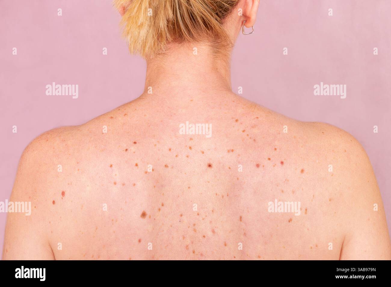 Close-up of a person's back with visible moles, highlighting the ...