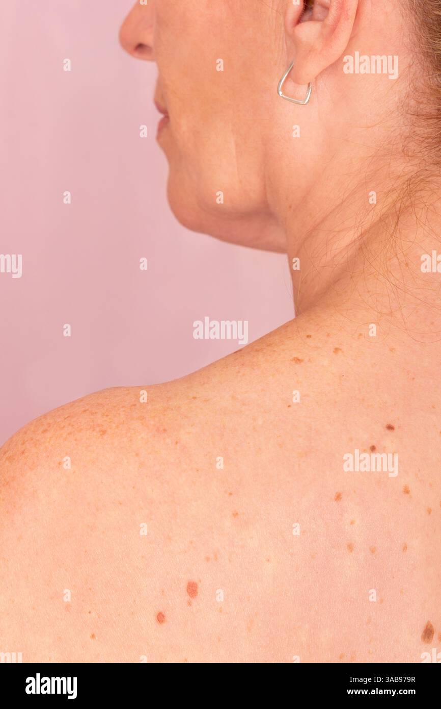 Close-up of a woman's skin with moles, promoting awareness against skin ...