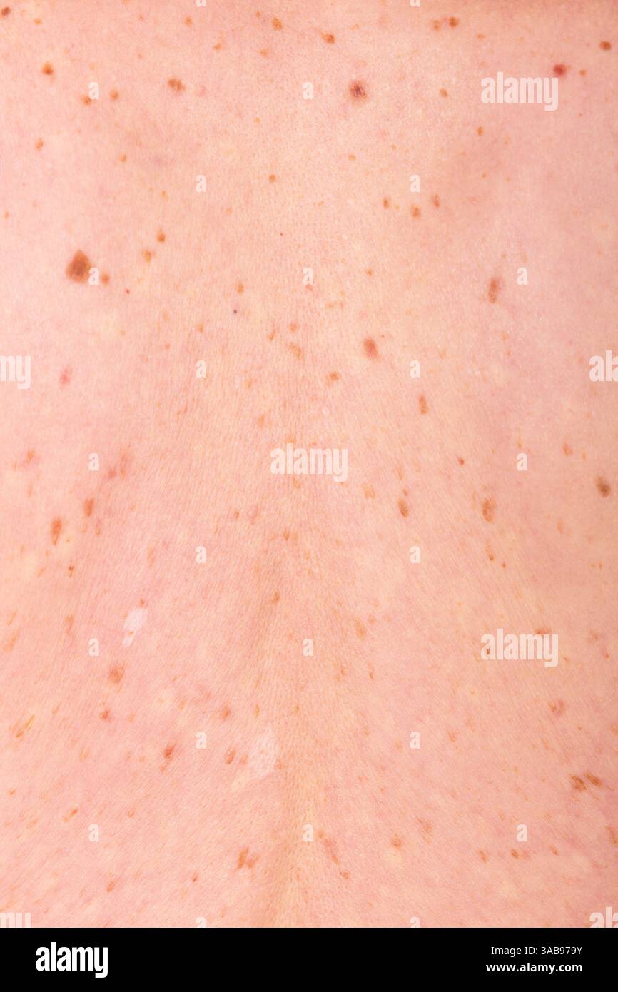 Close-up image of skin with freckles, highlighting the importance of ...